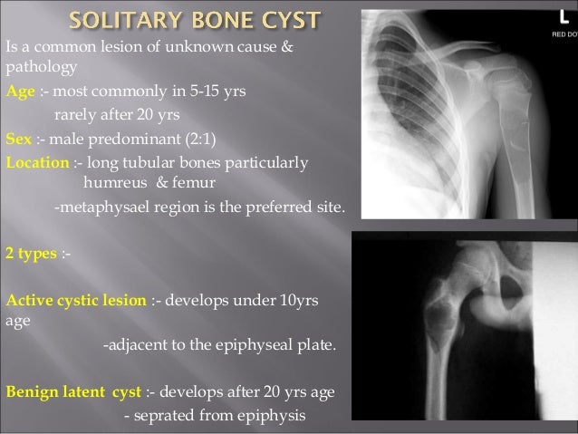Cystic lesion of bones