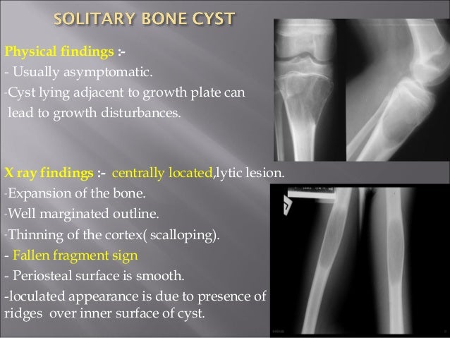 Cystic lesion of bones