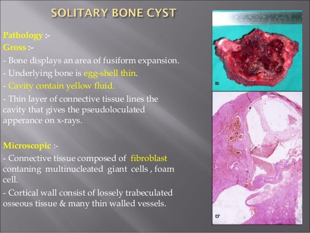 Cystic lesion of bones