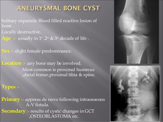 Cystic lesion of bones