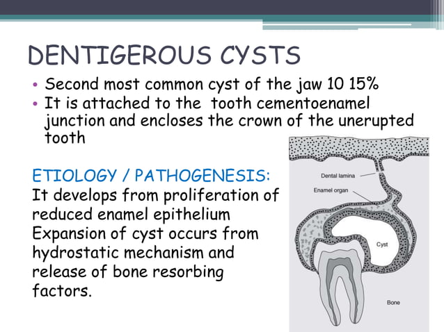 Cystic lesions in oral cavity | PPTX | Bone and Joint Conditions ...