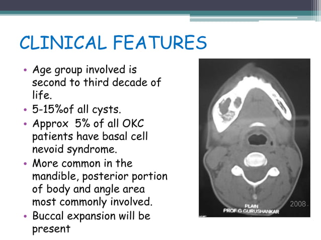 Cystic lesions in oral cavity | PPTX | Bone and Joint Conditions ...