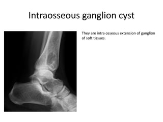 Cystic lesions of bone | PPTX