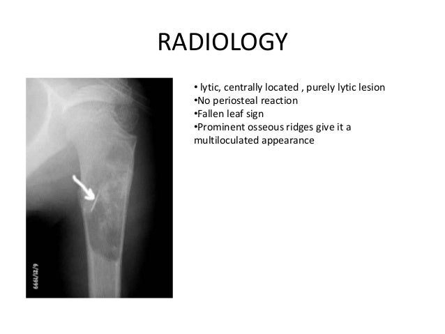 Cystic lesions of bone