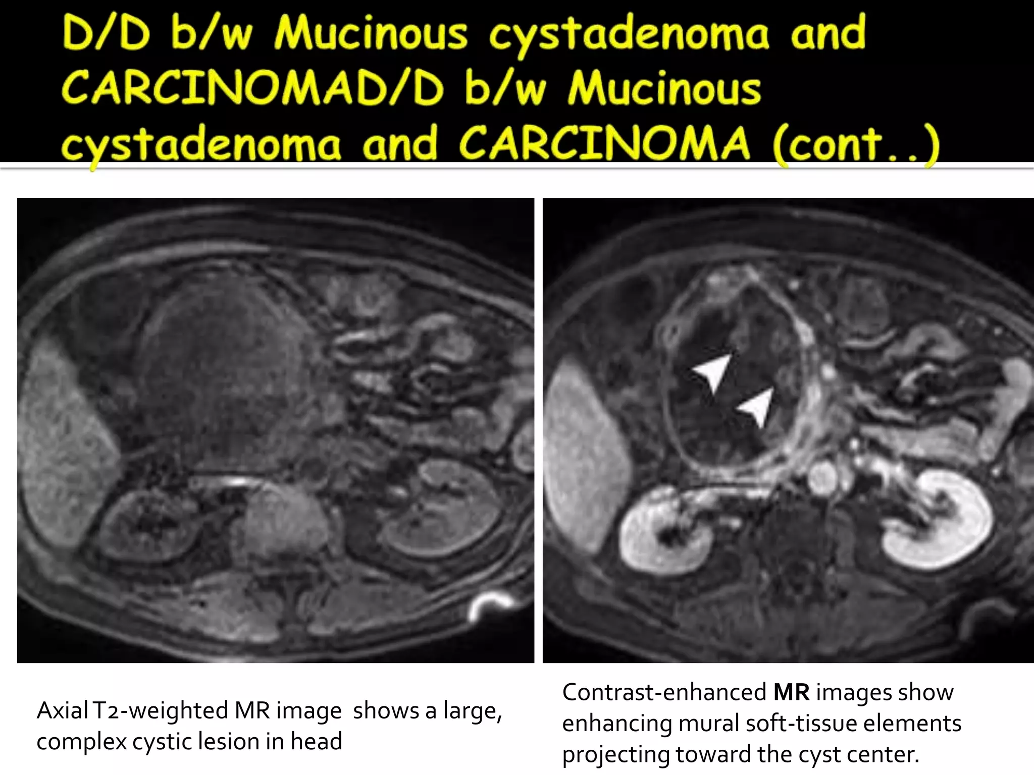 Cystic lesions of pancreas | PPTX