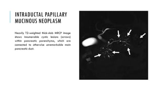 Imaging features of Cystic Lesions of the Pancreas | PPTX