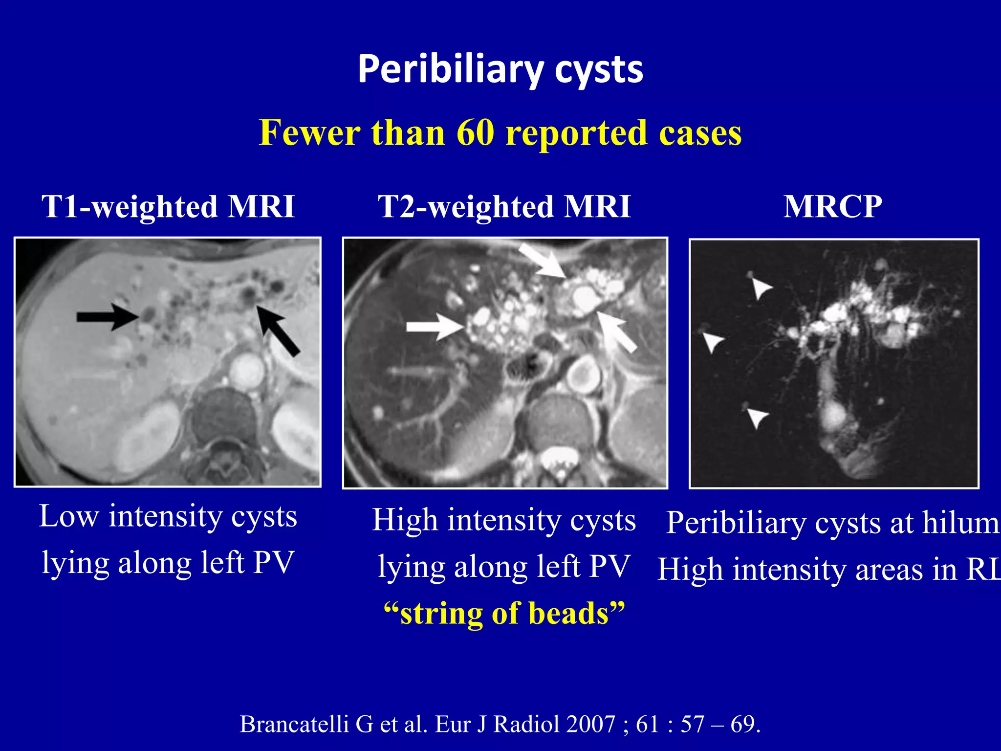 Cystic liver lesions - An ultrasound perspective | PPTX