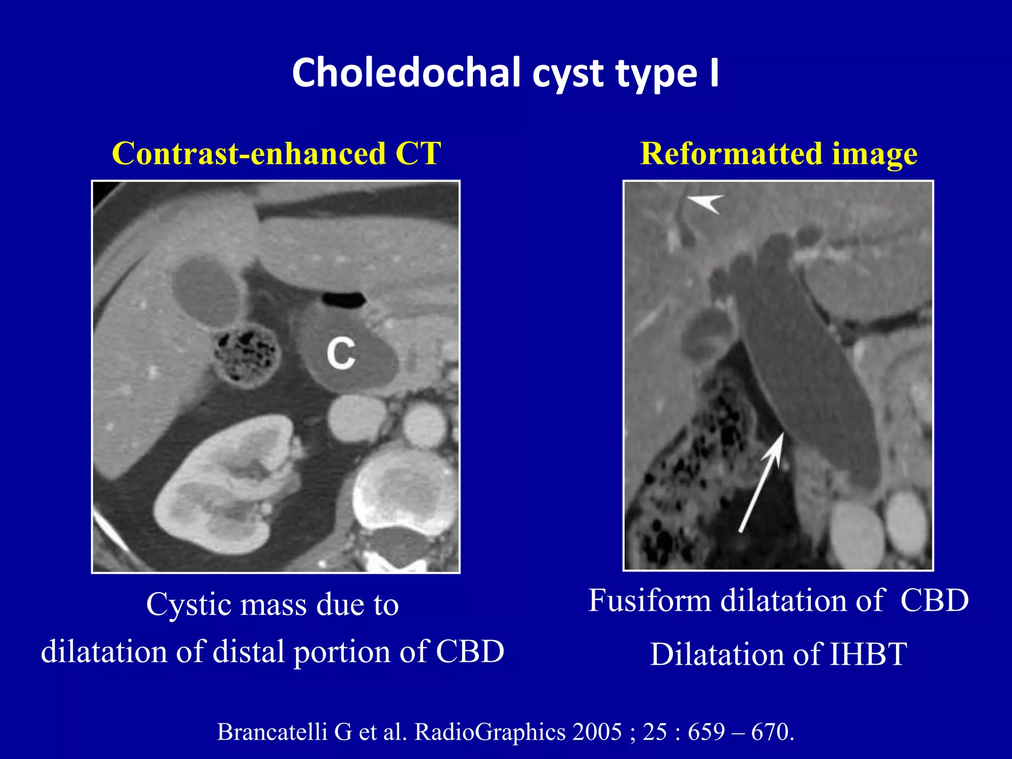 Cystic liver lesions - An ultrasound perspective | PPTX
