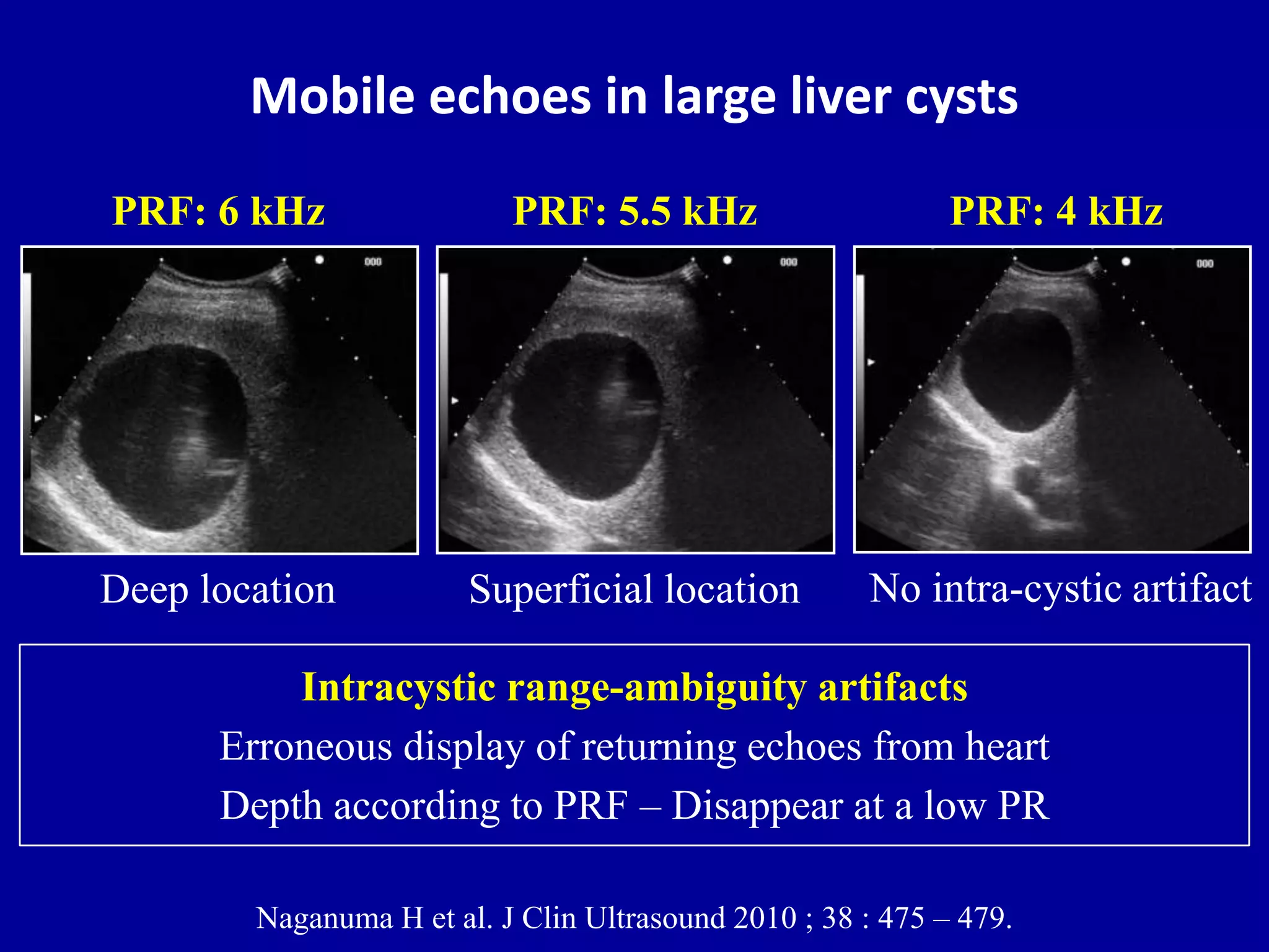 Cystic liver lesions - An ultrasound perspective | PPTX