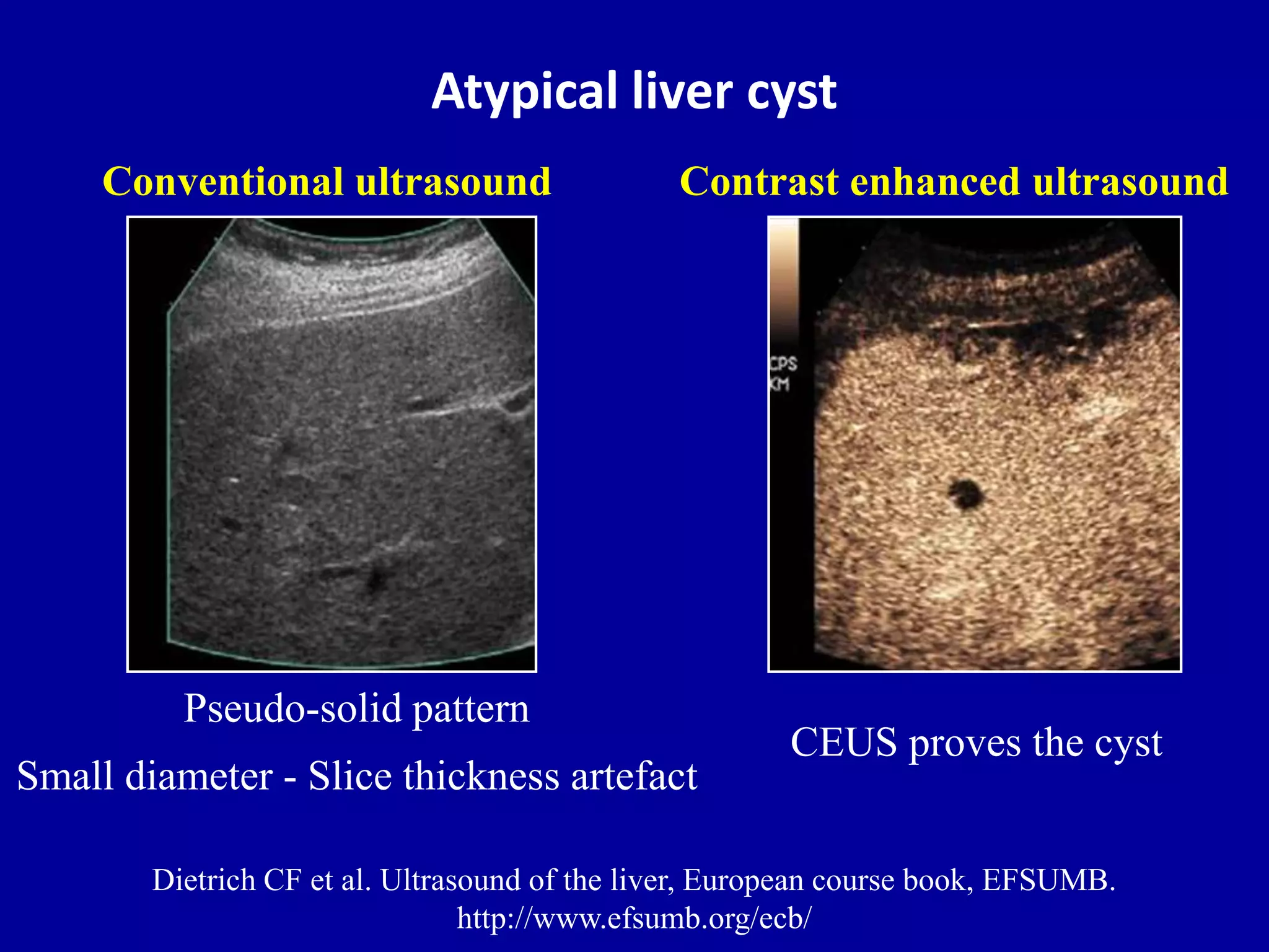 Cystic liver lesions - An ultrasound perspective | PPTX