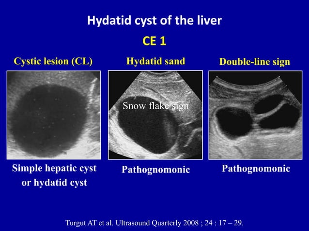 Cystic liver lesions - An ultrasound perspective | PPTX