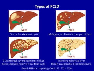 Cystic liver lesions - An ultrasound perspective | PPTX