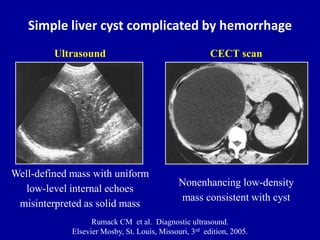 Cystic liver lesions - An ultrasound perspective | PPTX