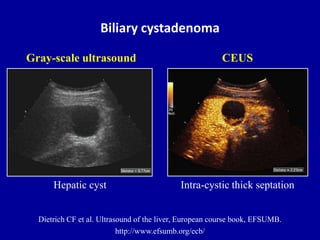 Cystic liver lesions - An ultrasound perspective | PPTX