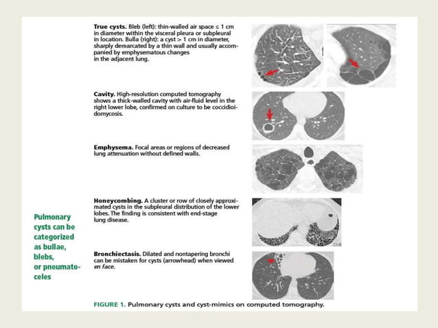 Cystic lung disease; Stepwise approach to diagnosis | PPTX
