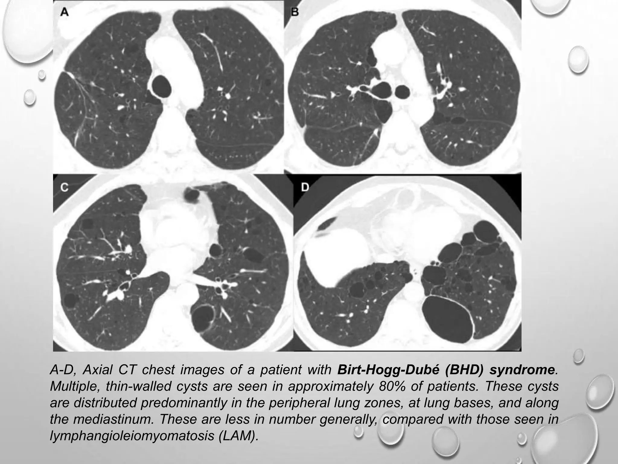 Cystic lung disease | PPTX