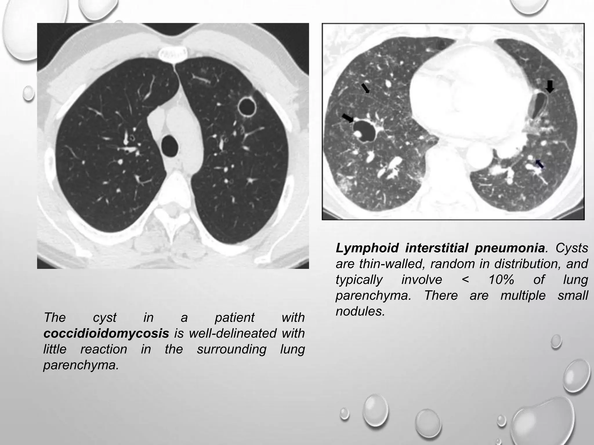 Cystic lung disease | PPTX