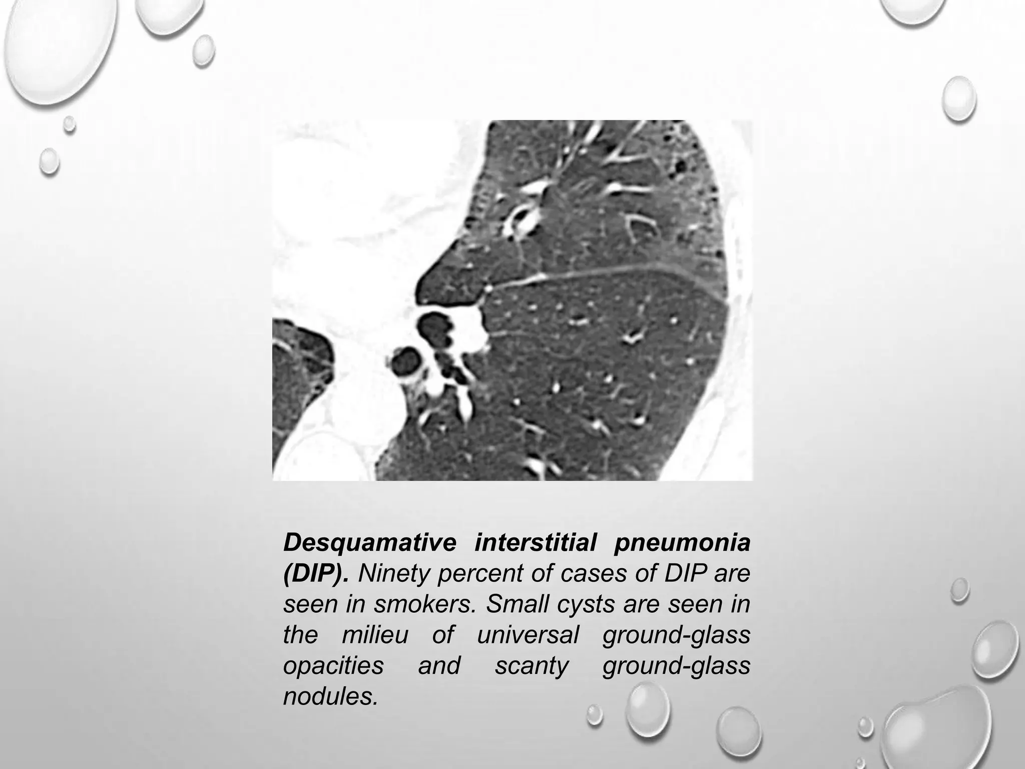 Cystic lung disease | PPTX