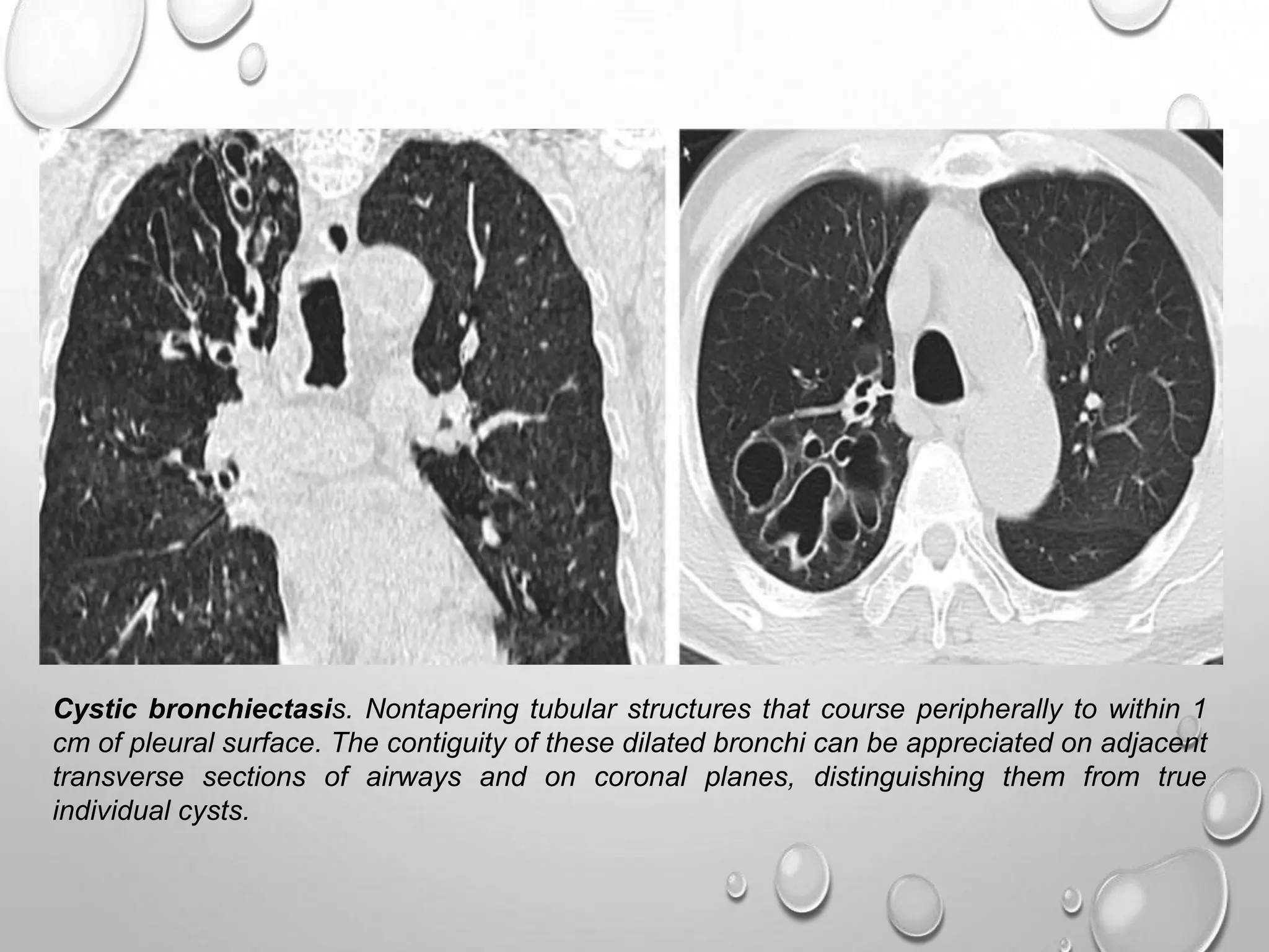 Cystic lung disease | PPTX