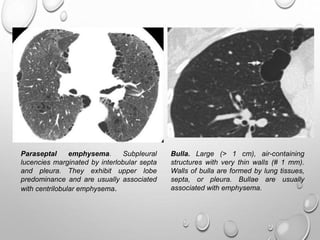 Cystic lung disease | PPTX