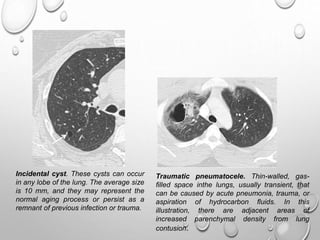 Cystic lung disease | PPTX