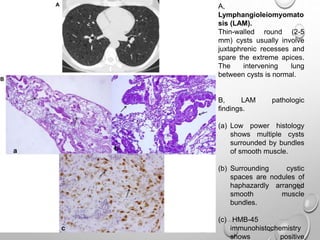 Cystic lung disease | PPTX