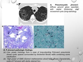 Cystic lung disease | PPTX