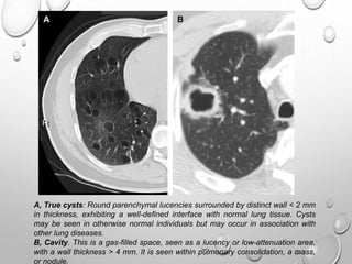 Cystic lung disease | PPTX