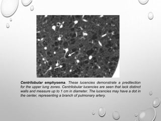 Cystic lung disease | PPTX