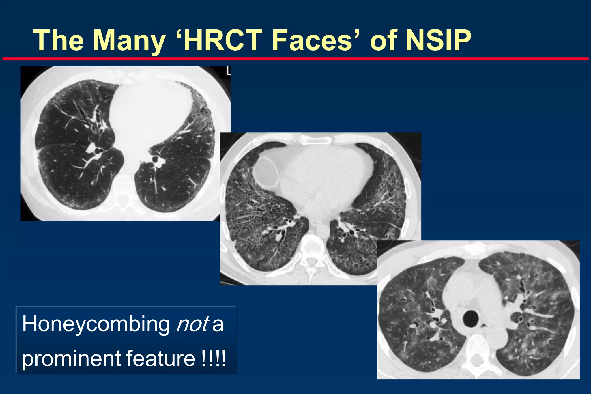Cystic lung diseases | PDF