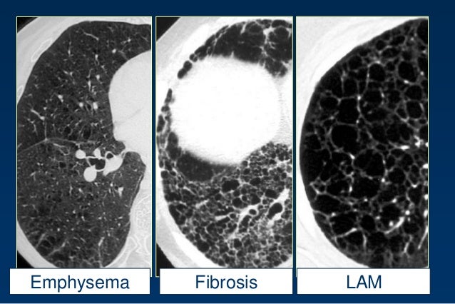 Cystic lung diseases