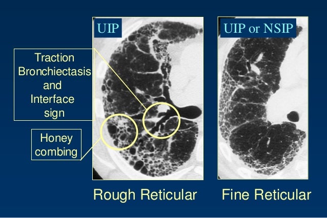 Cystic lung diseases