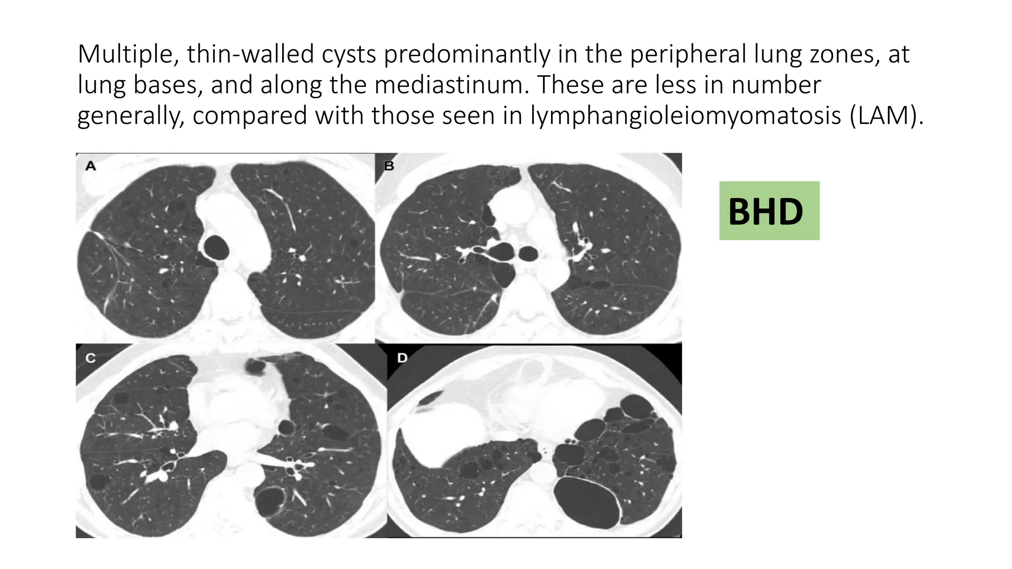 CYSTIC LUNG DISEASES - types and Radiology.pptx