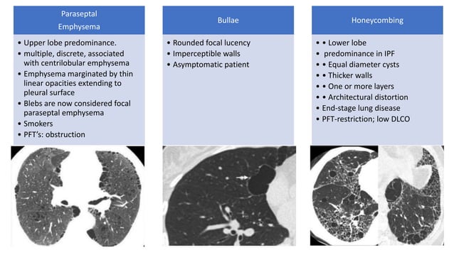 CYSTIC LUNG DISEASES - types and Radiology.pptx