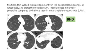 CYSTIC LUNG DISEASES - types and Radiology.pptx