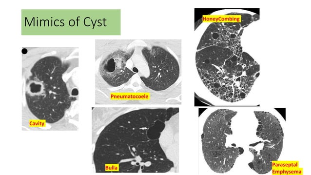 CYSTIC LUNG DISEASES - types and Radiology.pptx