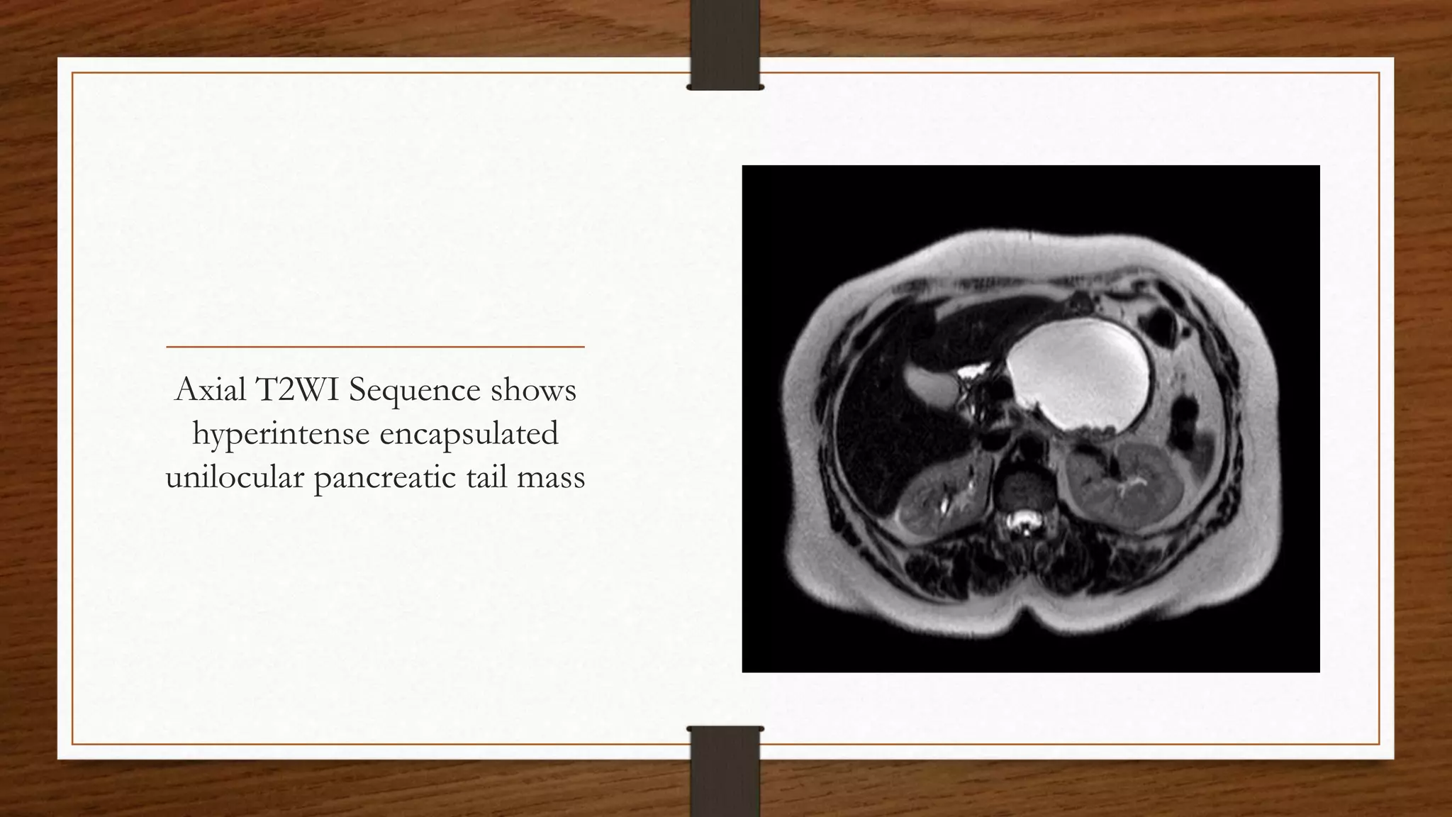 Cystic masses of pancreas.pptx