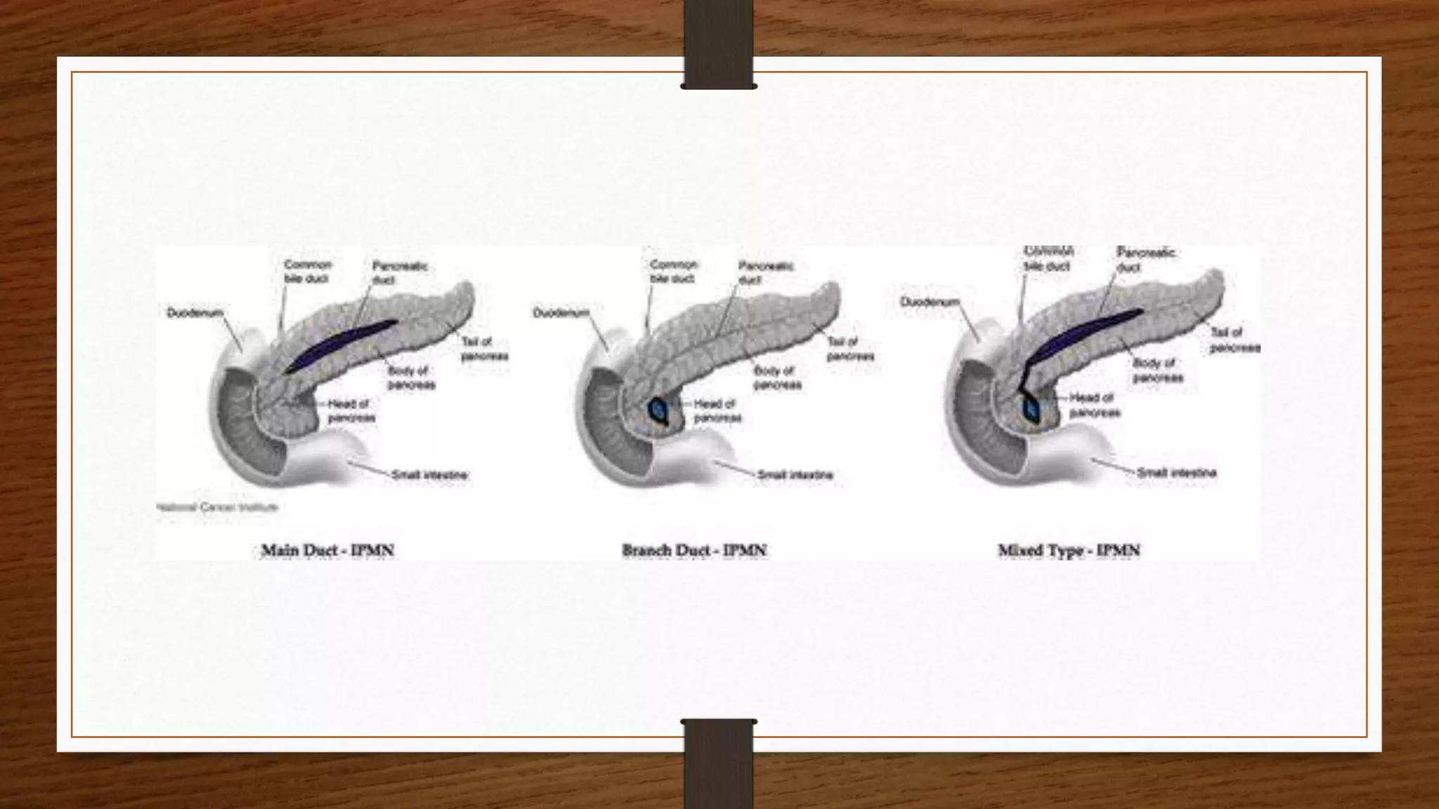 Cystic masses of pancreas.pptx
