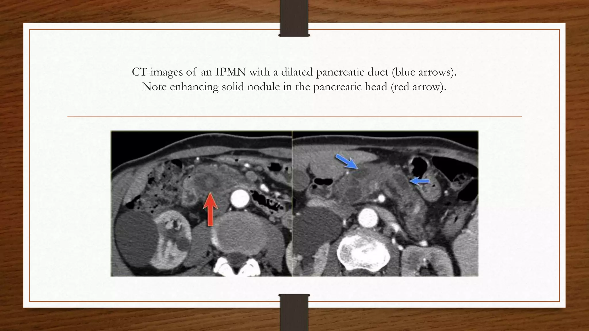 Cystic masses of pancreas.pptx