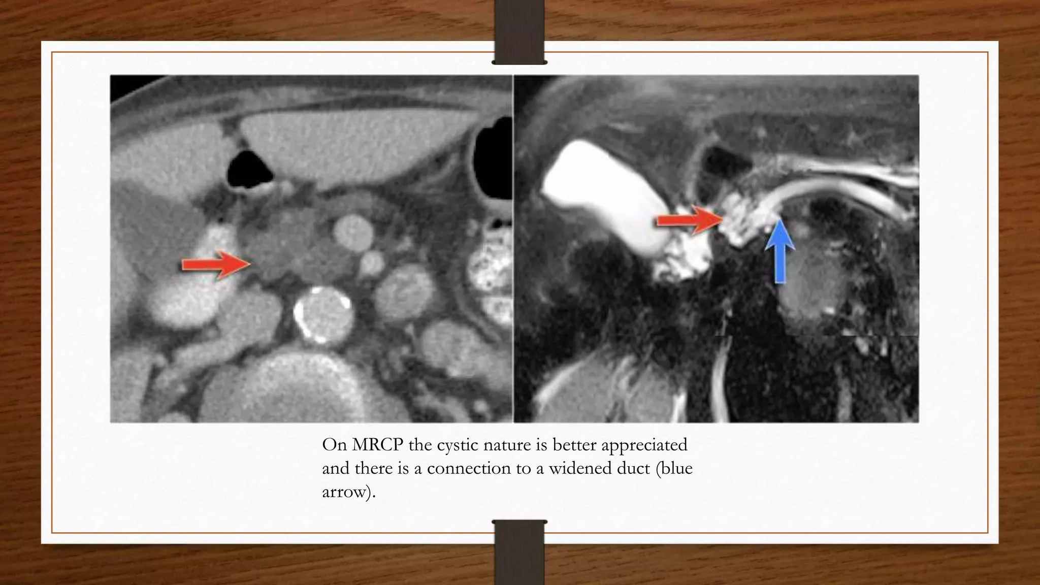 Cystic masses of pancreas.pptx