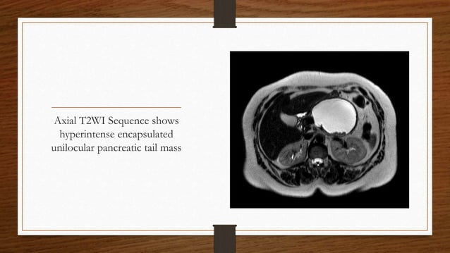 Cystic masses of pancreas.pptx