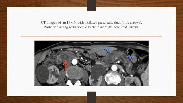 Cystic masses of pancreas.pptx