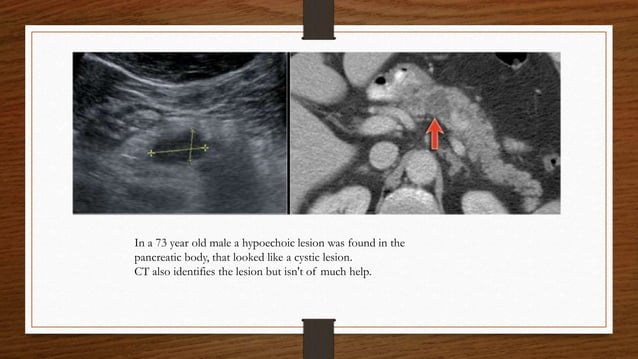 Cystic masses of pancreas.pptx