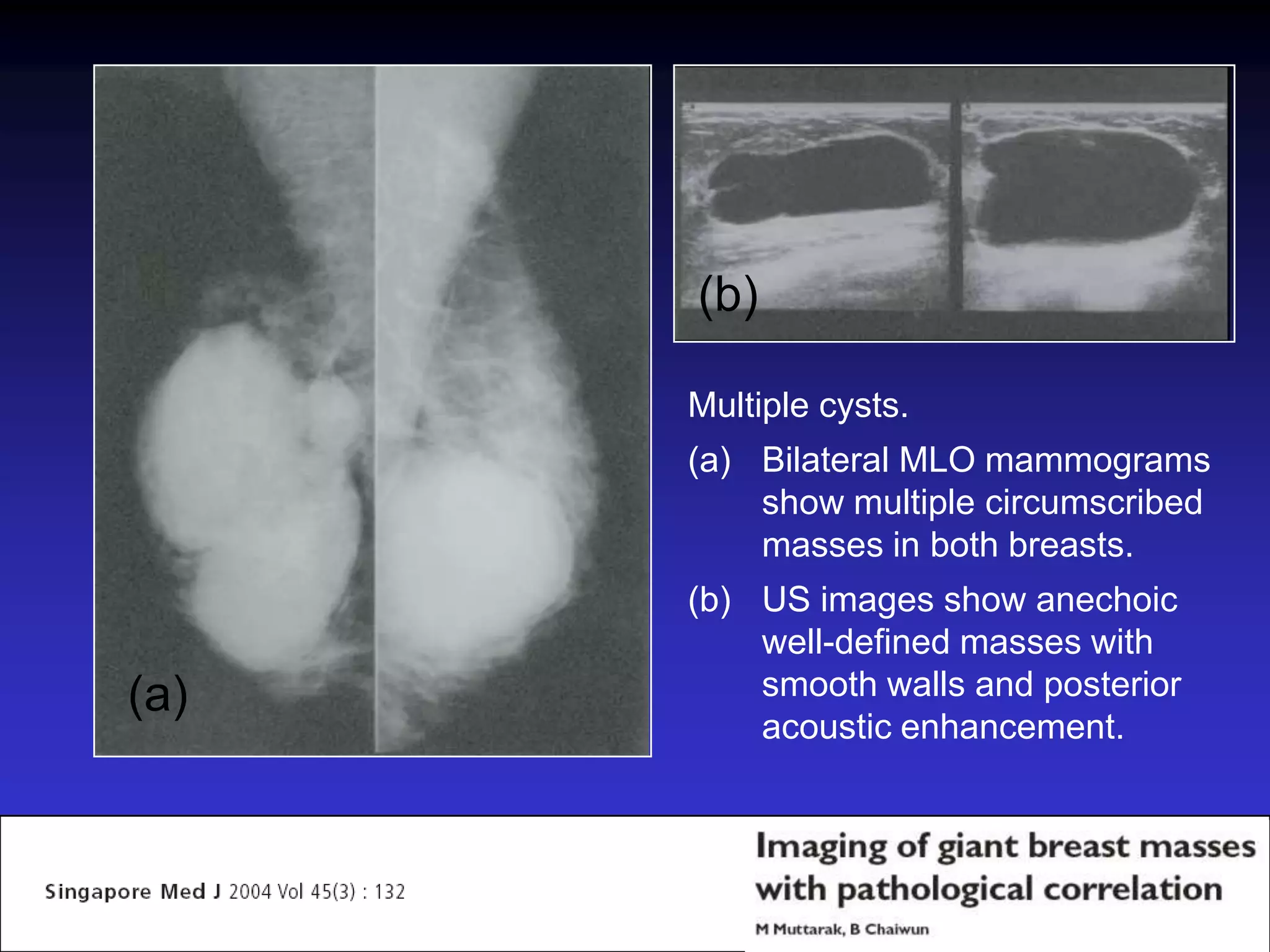Cystic masses of the breast by xiu | PPT