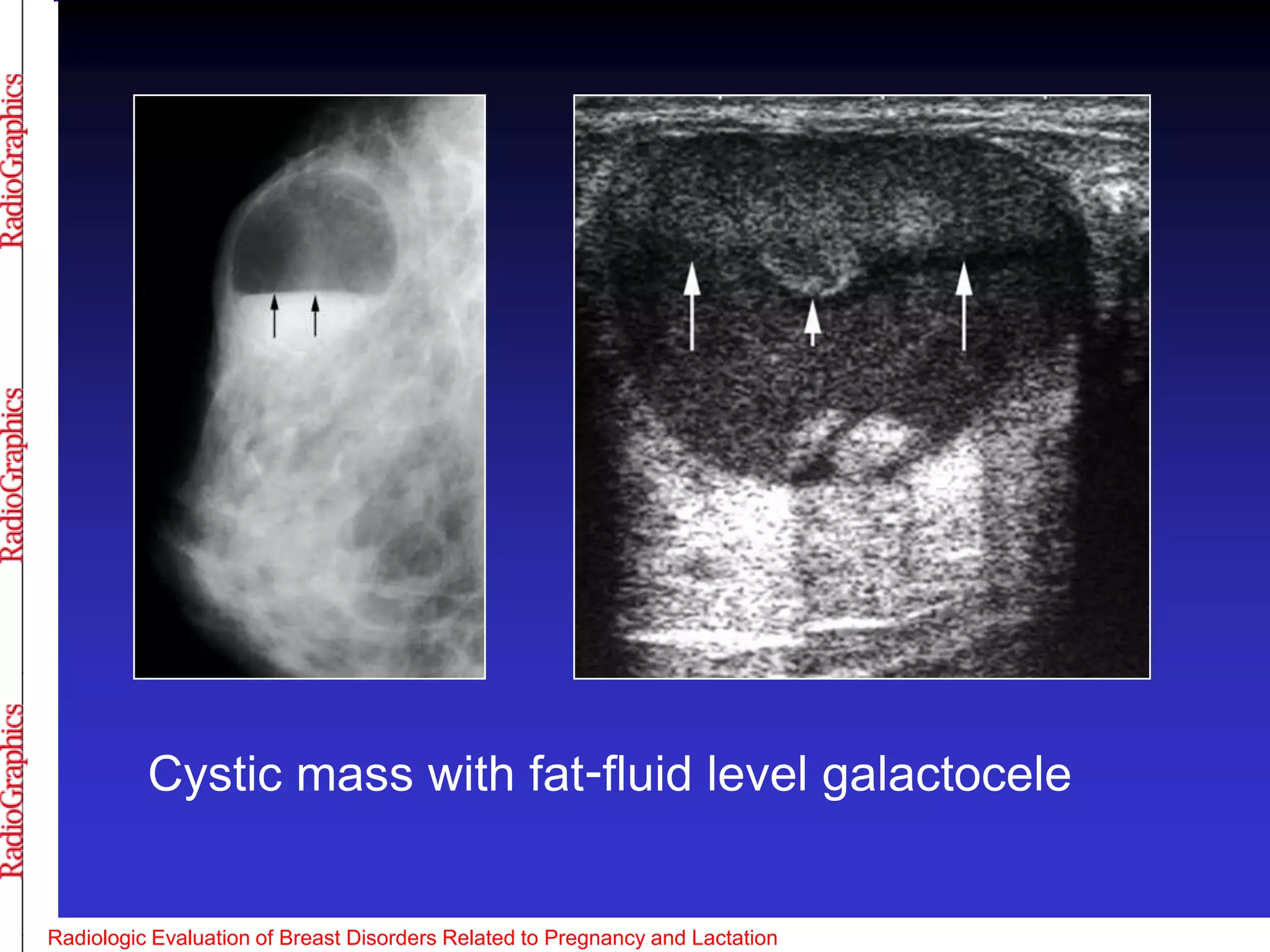 Cystic masses of the breast by xiu | PPT