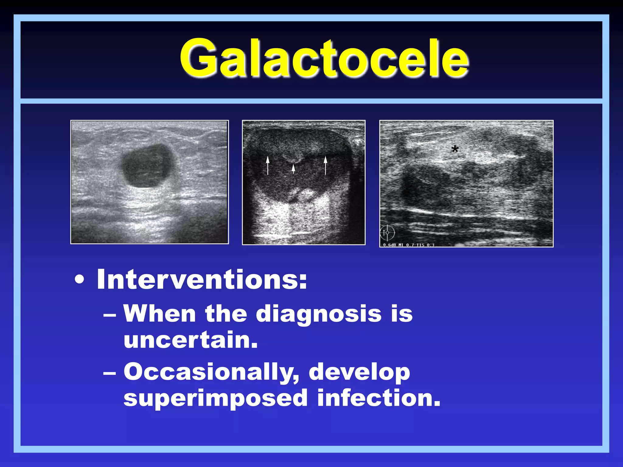 Cystic masses of the breast by xiu | PPT
