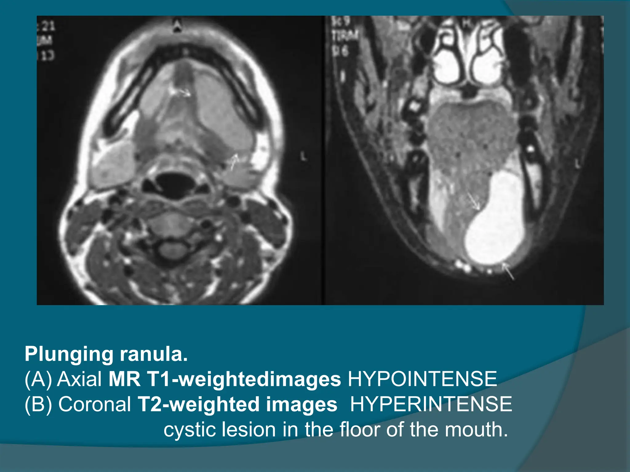 cystic neck lesions congenital and acquired | PPTX