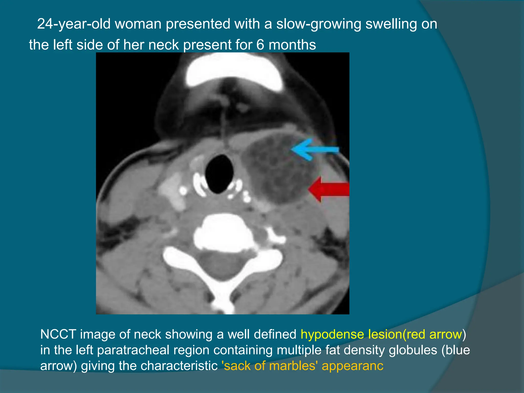 cystic neck lesions congenital and acquired | PPTX
