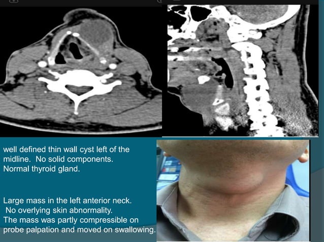 cystic neck lesions congenital and acquired | PPT