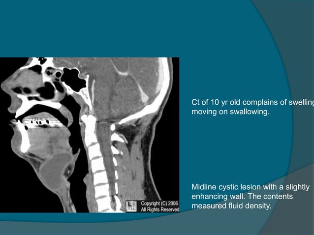 cystic neck lesions congenital and acquired | PPT